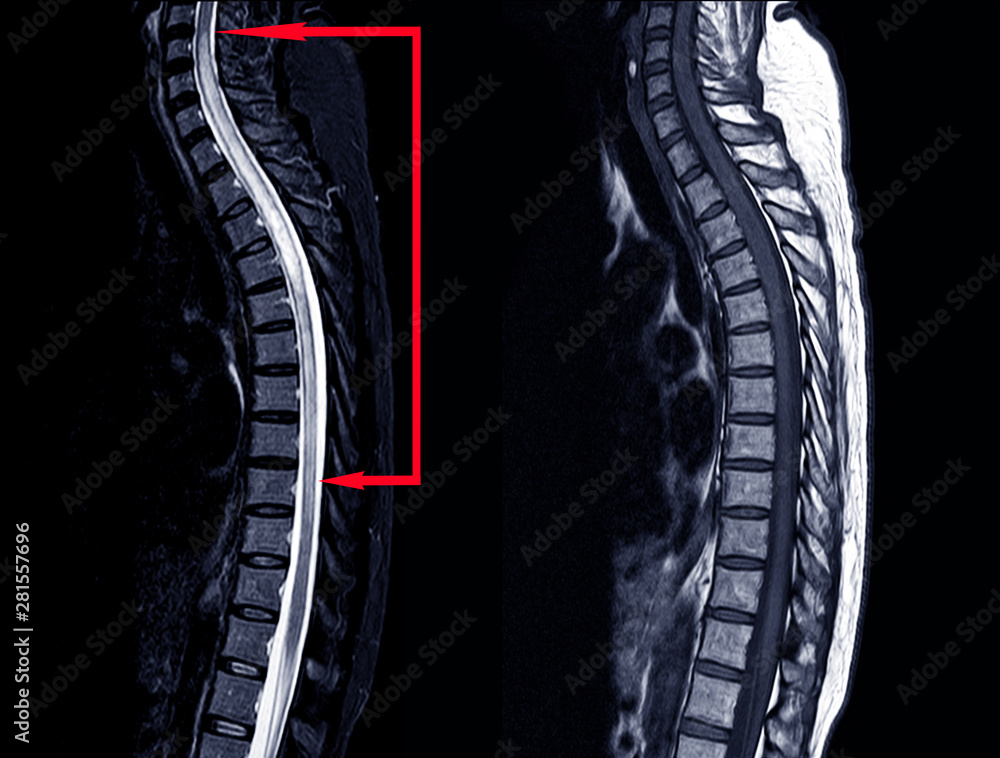 Normal Thoracic Spine Mri