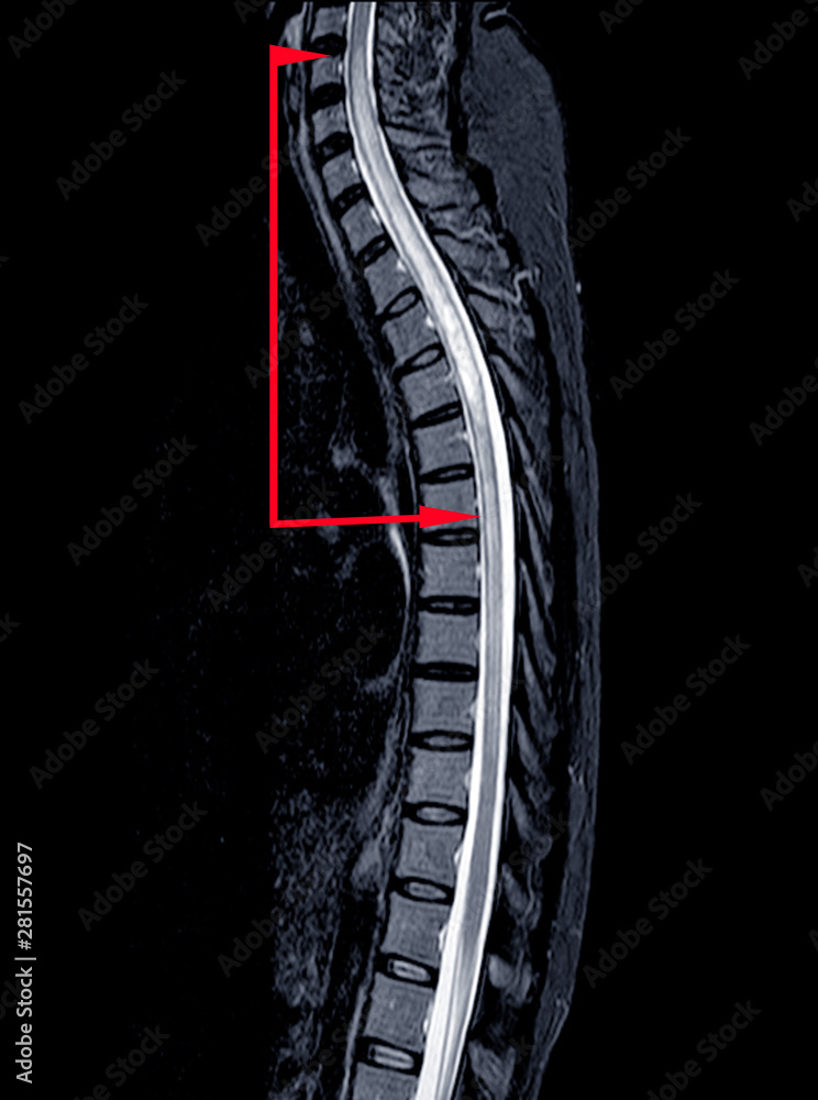MRI OF THORACIC SPINE HISTORY: A 53-year-old woman, presented with ...