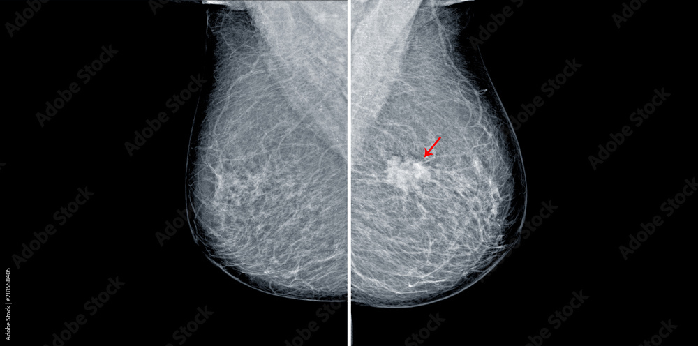 Mammogram radio imaging for breast cancer diagnosis Stock Photo | Adobe ...