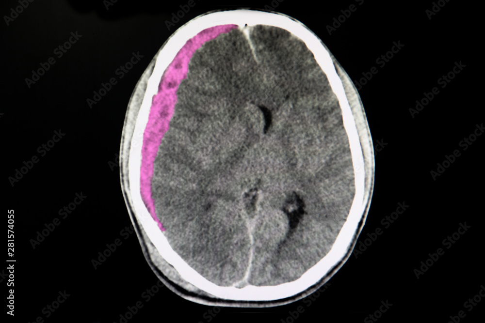 CT brain scan with acute subdural hematoma Stock Photo | Adobe Stock