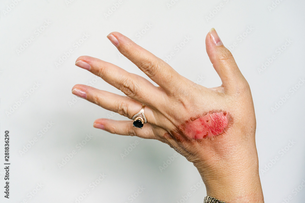 An open wound of woman's hand with thermal burn of second degree injury ...