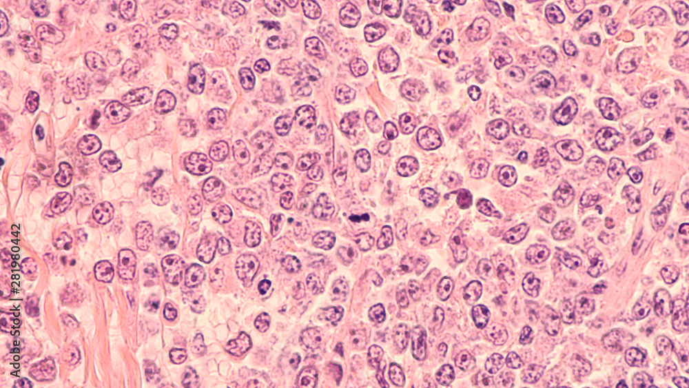 Lymphoma awareness: photomicrograph of a diffuse large B-cell lymphoma (DLBCL) a type of non ...