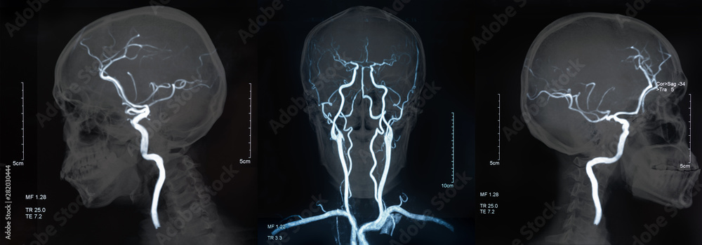 mri blood vessels Stock Photo | Adobe Stock