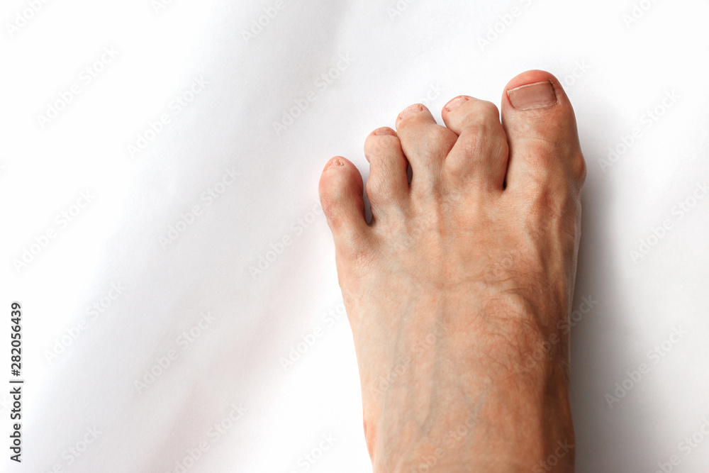 rheumatoid arthritis or gout affects the toes of young caucasian man ...