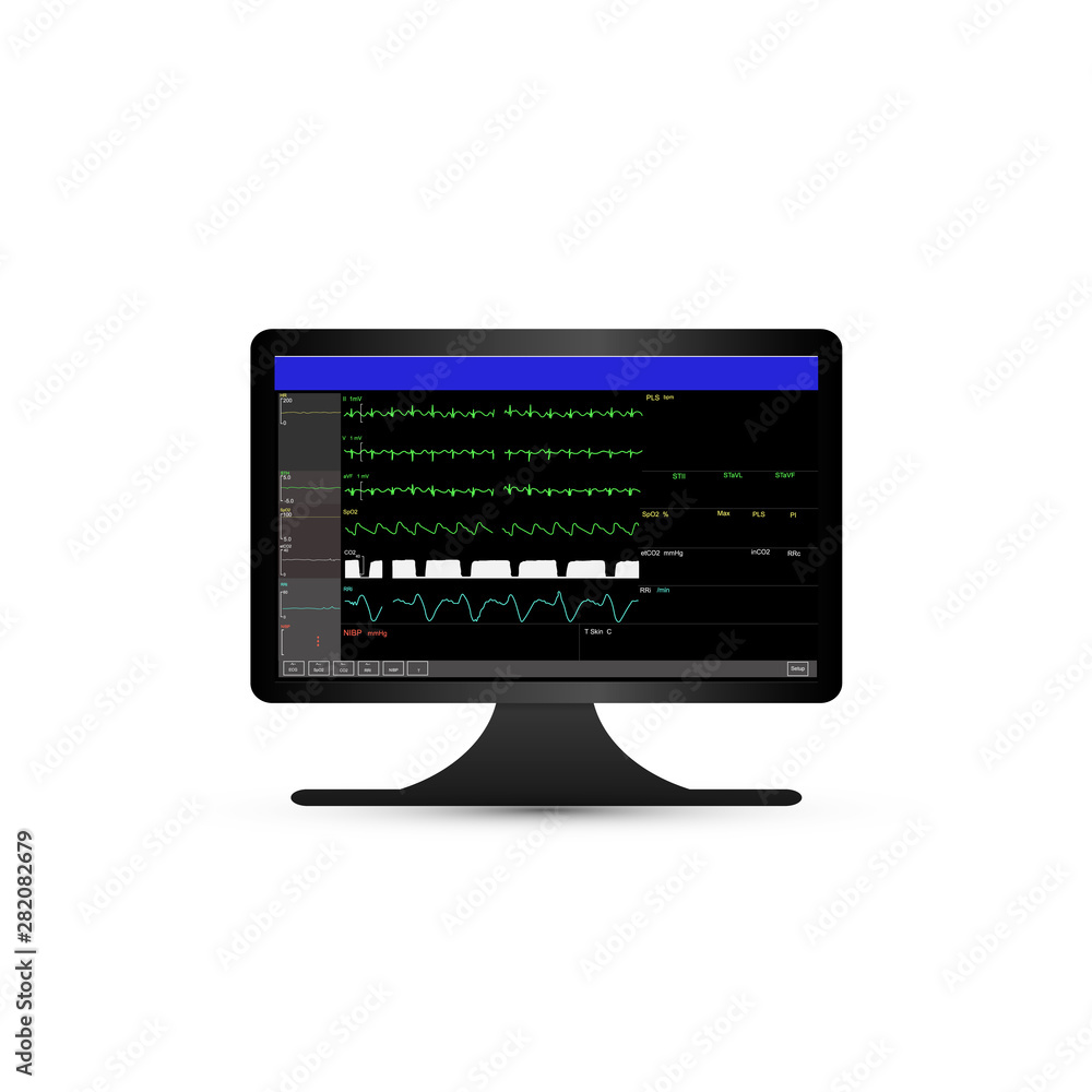 Computer monitoring and screen display of patient vital signs of ...