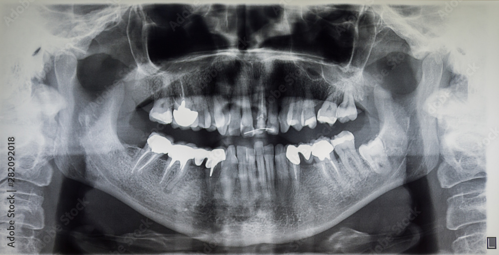 Orthopantomography of an adult patient Stock Photo | Adobe Stock