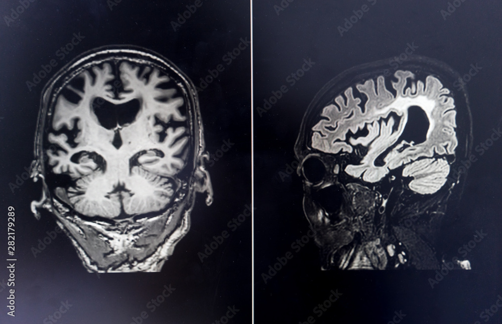 brain MRI for education Dementia Mix type stroke VaD Stock Photo ...