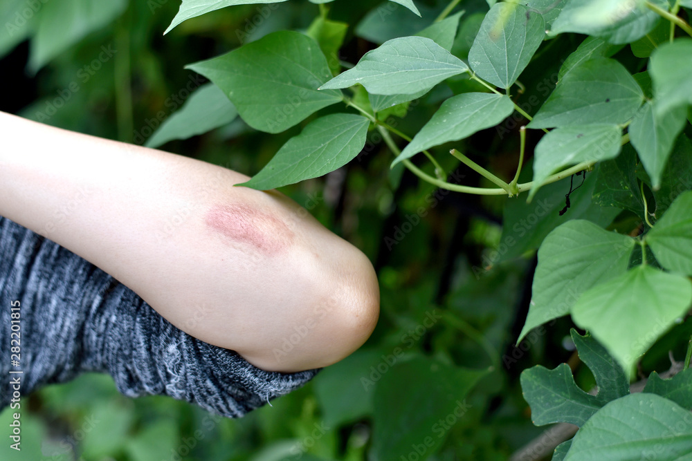 Skin allergy diseases problem, Poison tree contact dermatitis rash ...