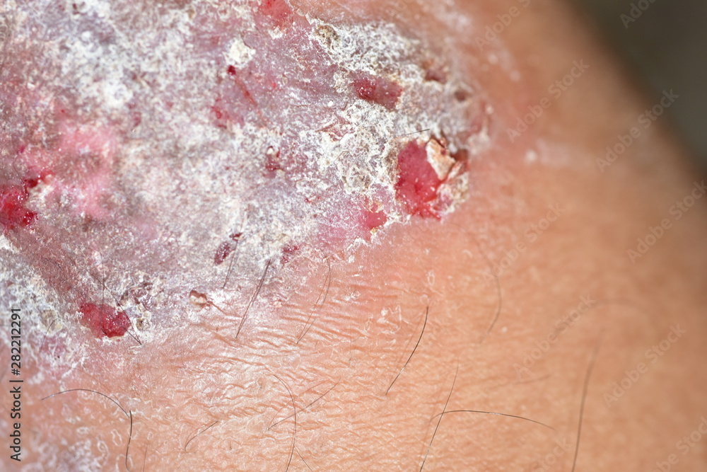 Lesions caused by fungal infections of the skin Stock Photo | Adobe Stock