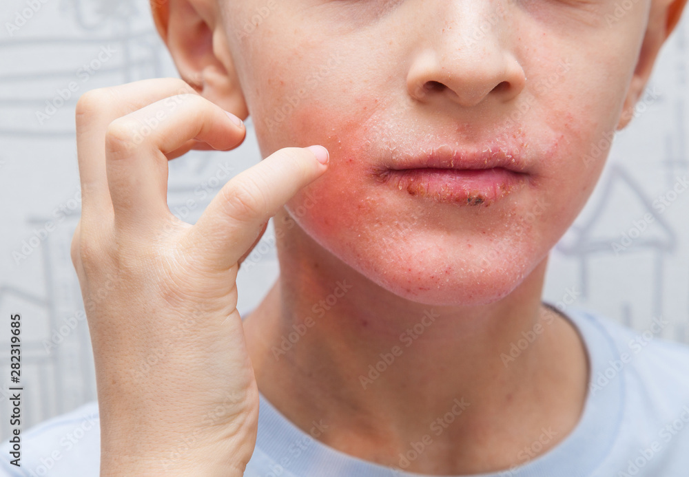 Boy scratching his face. Human skin, presenting an allergic reaction ...