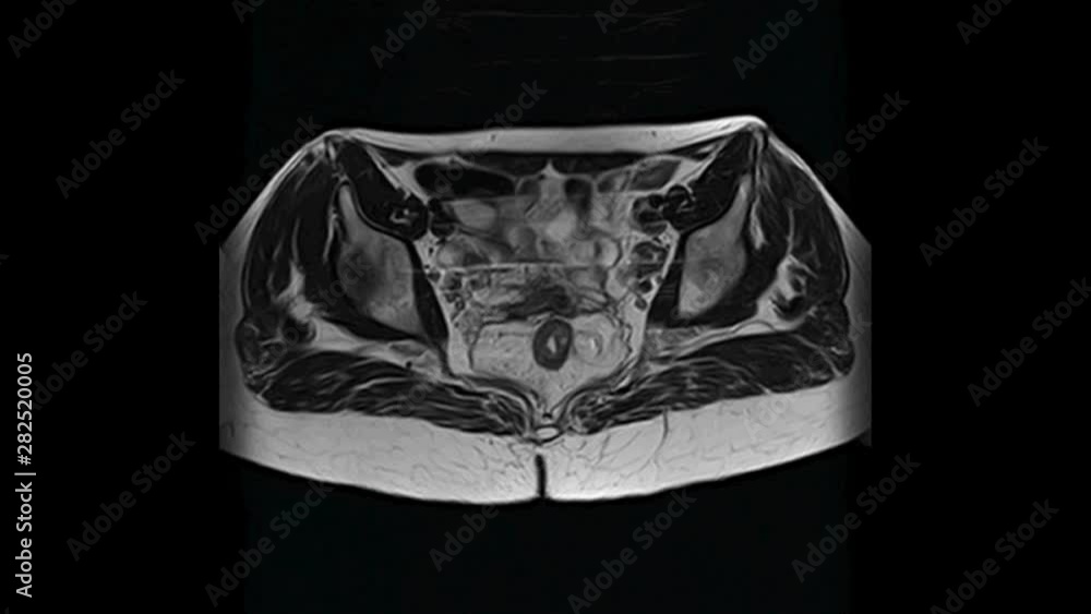 Contrast MRI scan of the abdominal cavity and retroperitoneal space ...