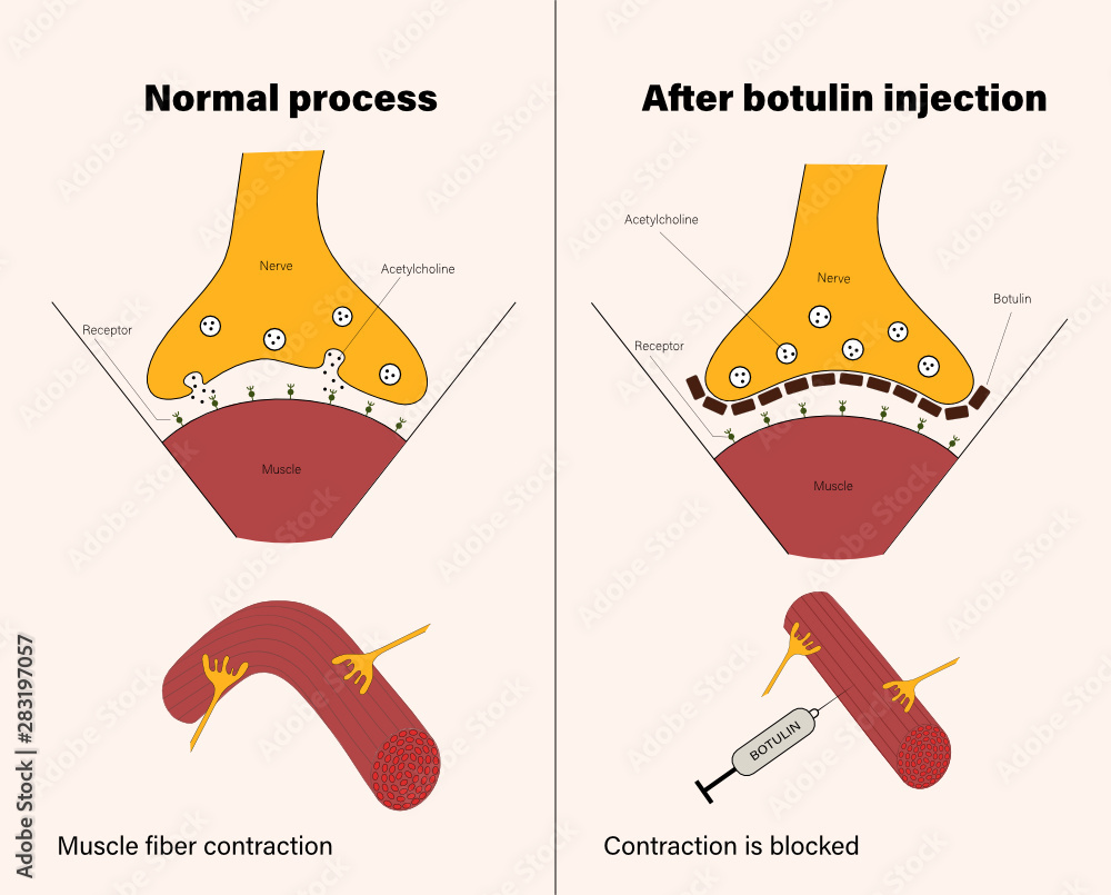 Drug made from the botulin botulinum toxin produced by bacterias used ...