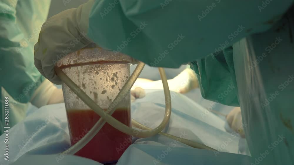 fat removal and Liposuction surgery Fat seeker. human fat in the pot ...