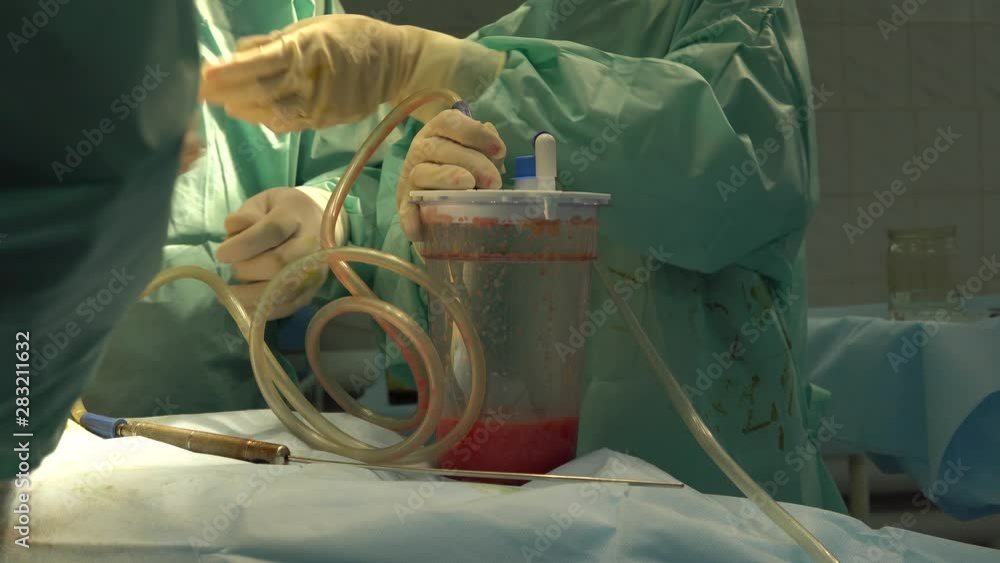 fat removal and Liposuction surgery Fat seeker. human fat in the pot ...