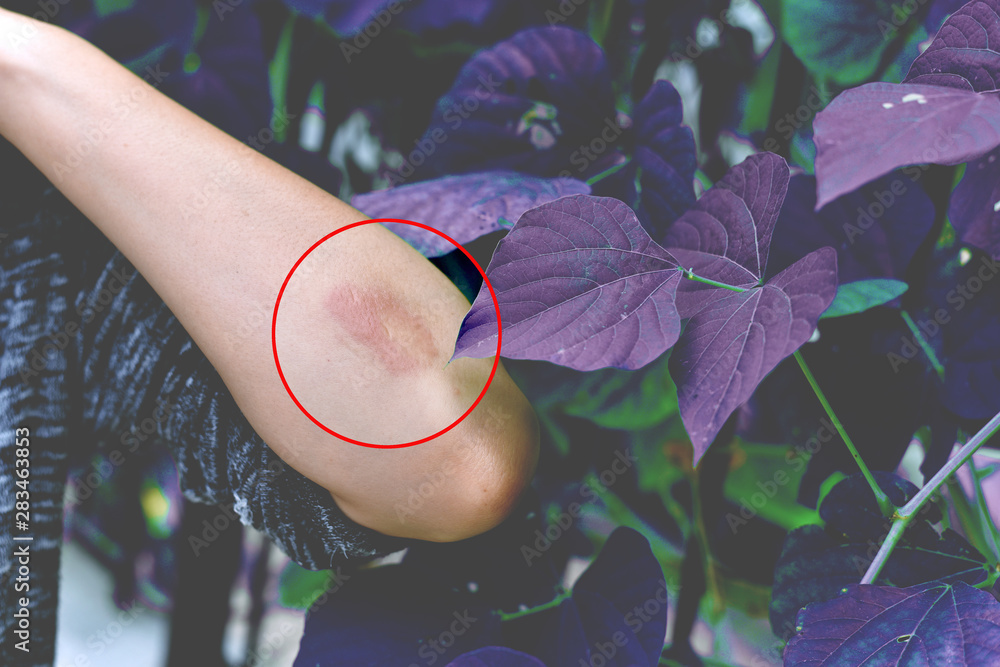 Skin allergy diseases problem, Poison tree contact dermatitis rash by ...