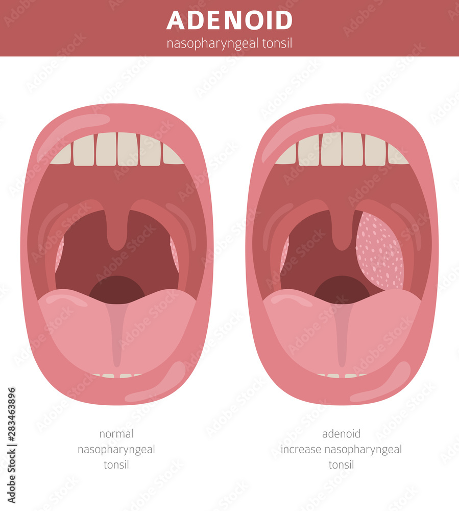 Nasal and throat, nasopharynx diseases. Adenoids diagnosis and ...