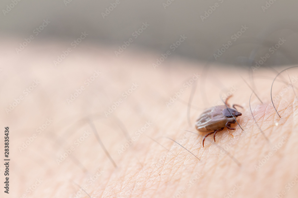 Tick filled with blood sitting on human skin. Stock Photo | Adobe Stock