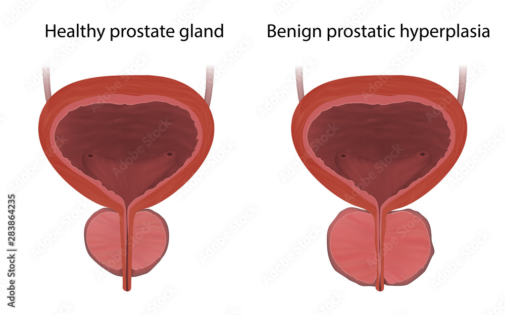 Benign prostatic hyperplasia and healthy prostate gland, comparison ...
