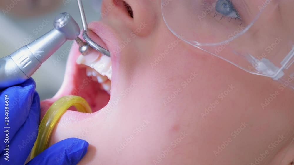 Dentist cleaning brushing and polishing woman's teeth uses drill ...