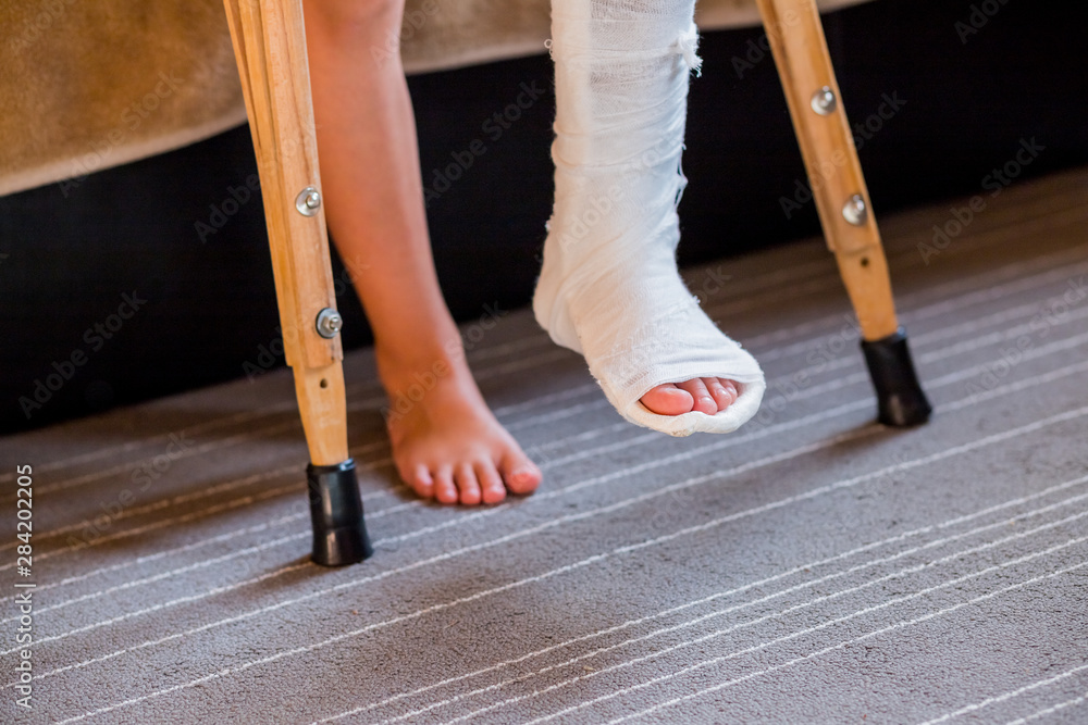 Broken leg in cast of unrecognizable little child.Young girl in ...
