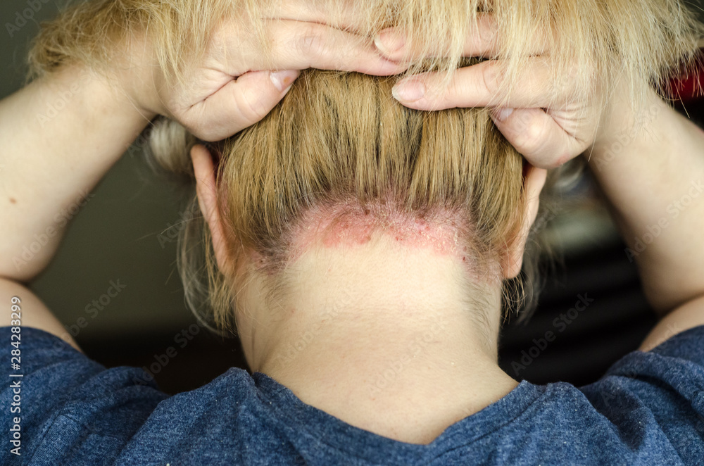 Dermatological skin disease. psoriasis, eczema, dermatitis, allergies ...