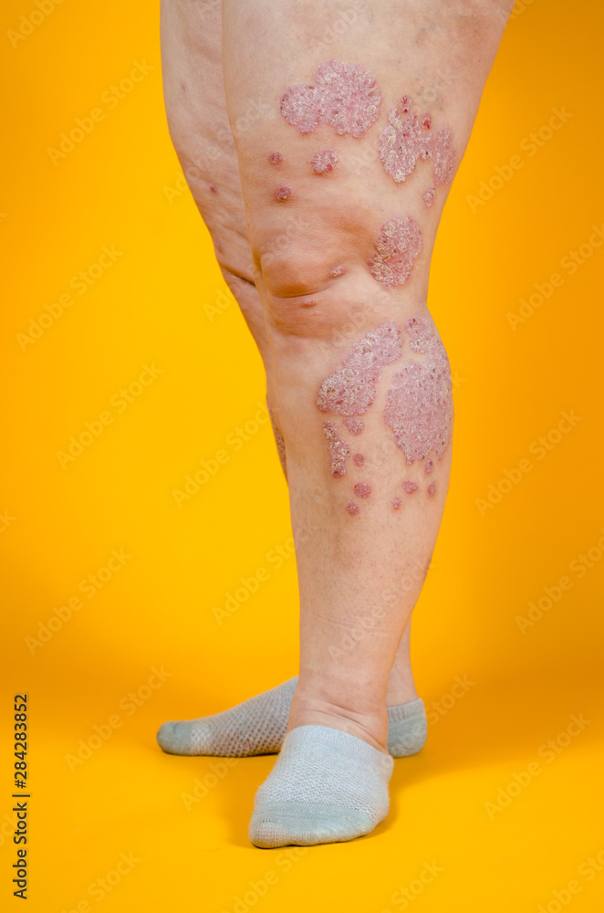 Skin Lesions On Legs