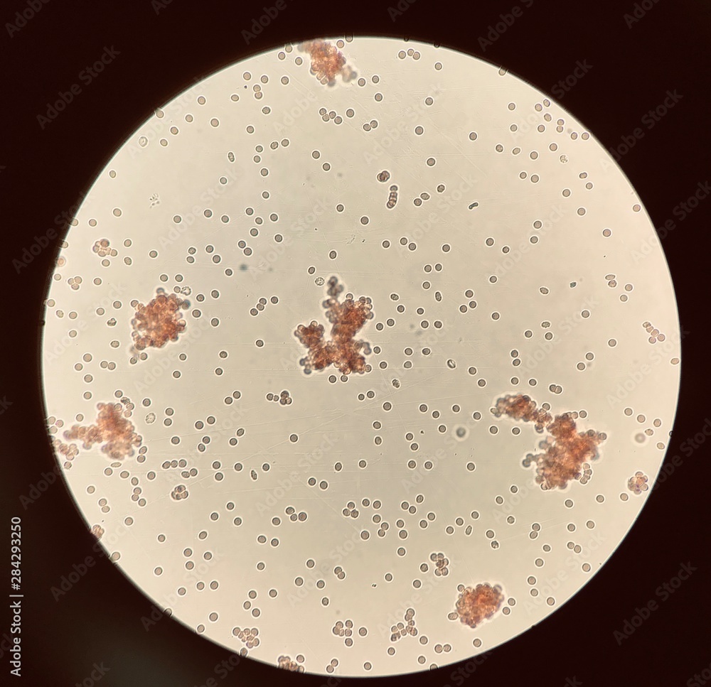 Red blood cells agglutination in crossmatching test incompatible ...