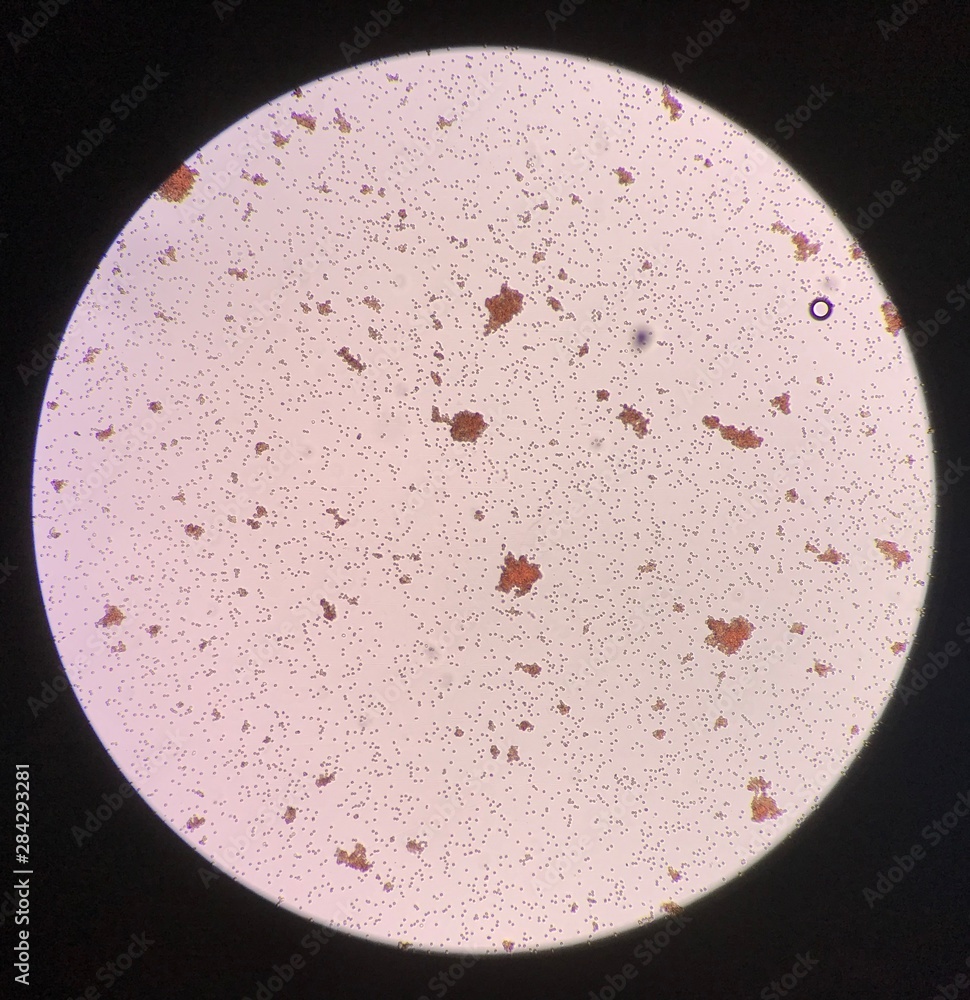 Red blood cells agglutination in crossmatching test incompatible ...