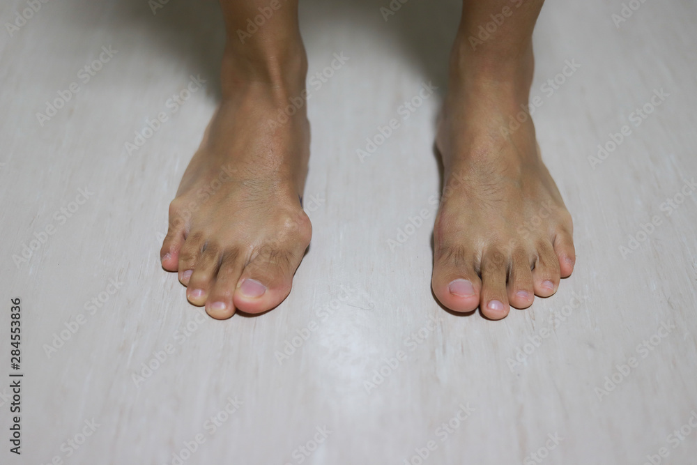 Hallux Valgus in an Asian girl before and after Proximal phalanx ...