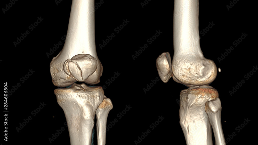CT SCAN 3D of right knee in AP & lateral position. Fracture patella ...
