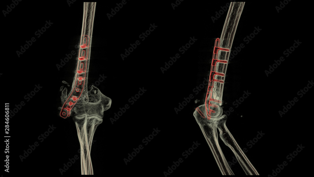 3D computed tomography (CT) of elbow with transparent bone ,metallic ...