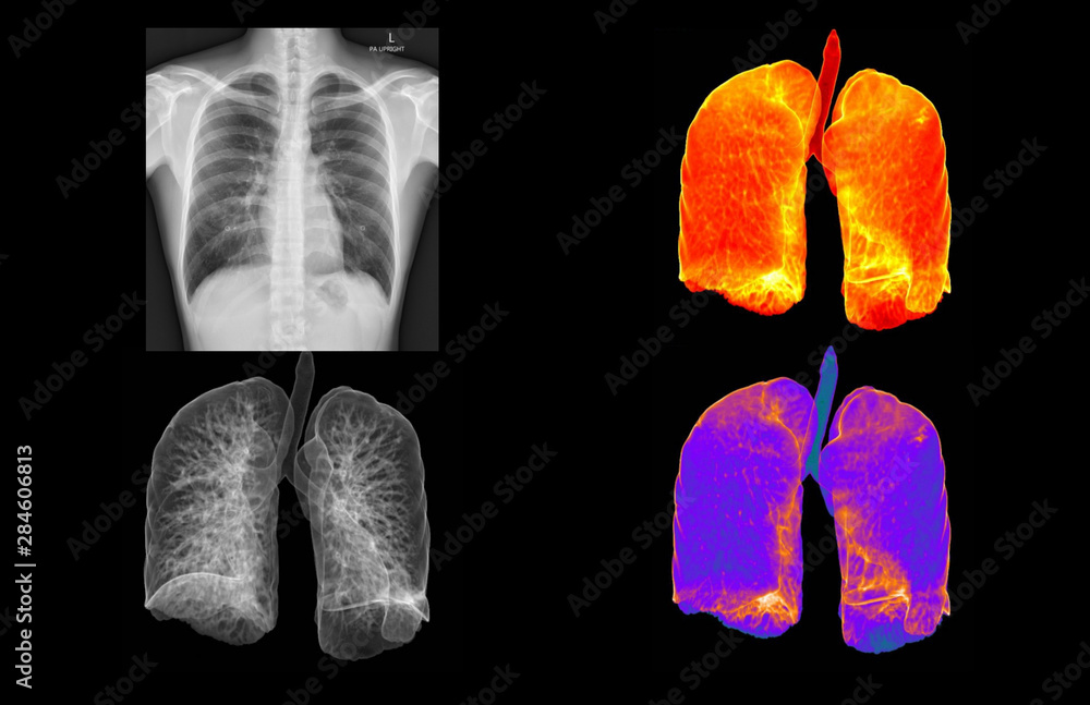 Anatomy of the lungs by transparency.CT 3D SCAN and chest x-ray film ...