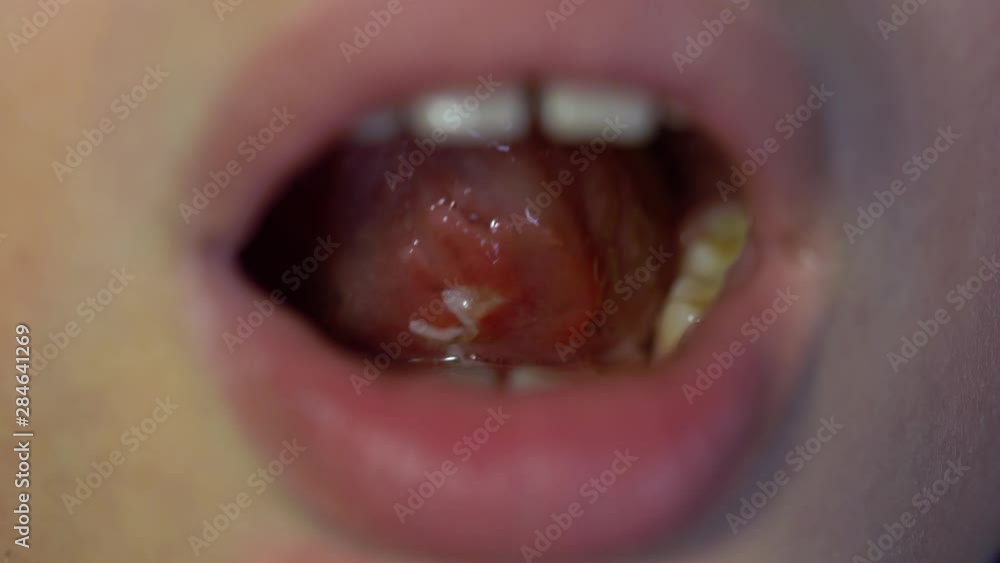 Child opens mouth to show white surgery stitches under tongue after ...