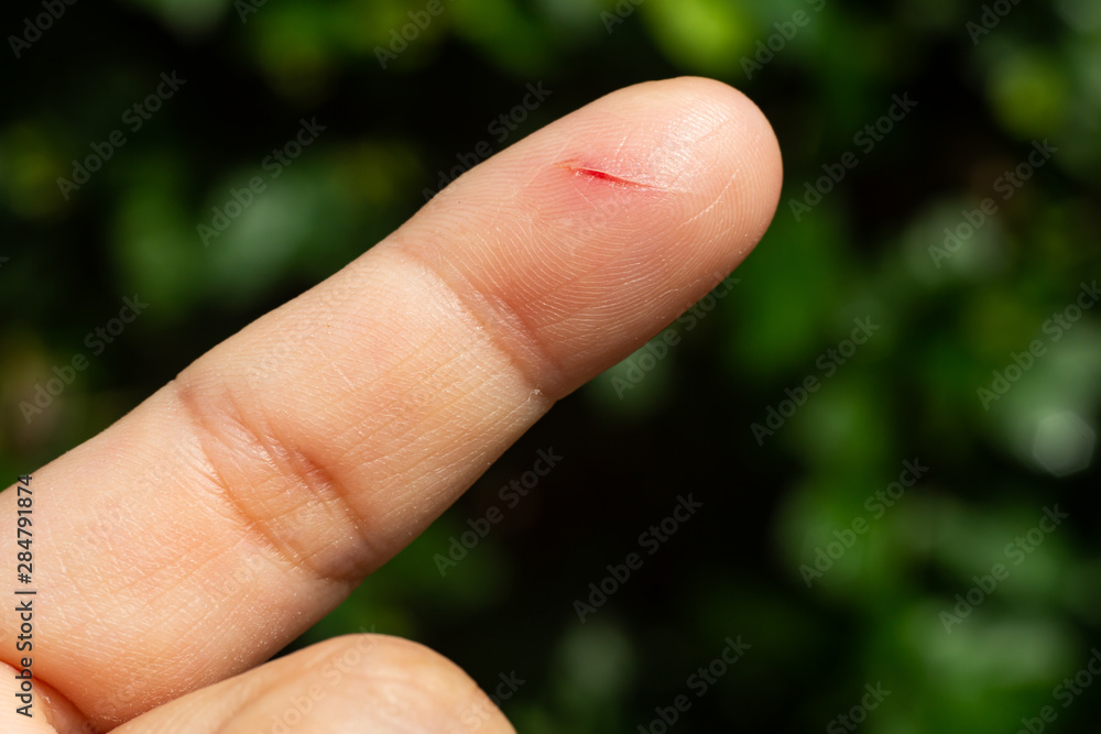 Woman has been cut index finger and scar skin on hand, Close up & Macro ...