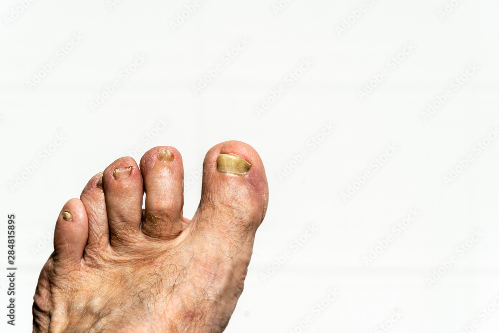 Fungus on toenail plate. Nail plates of toes are disfigured by fungus ...