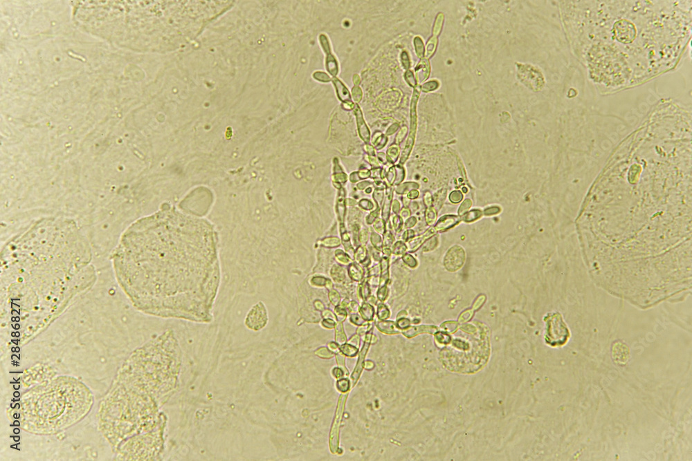 Pseudohyphae and budding yeast cells in patient urine (urinary tract ...