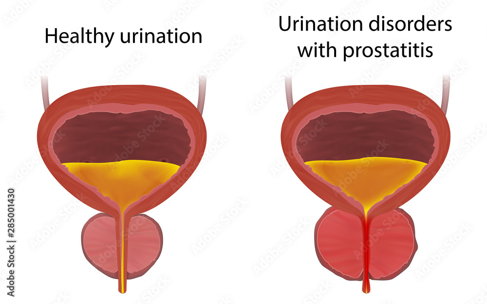 Urinary disorders with Prostatitis and healthy urination, comparison ...