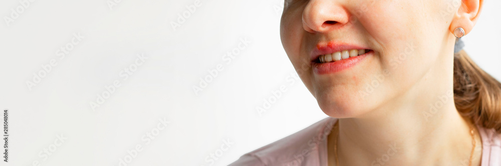 Lower part part of smiling woman face with Red bubbles of virus herpes ...