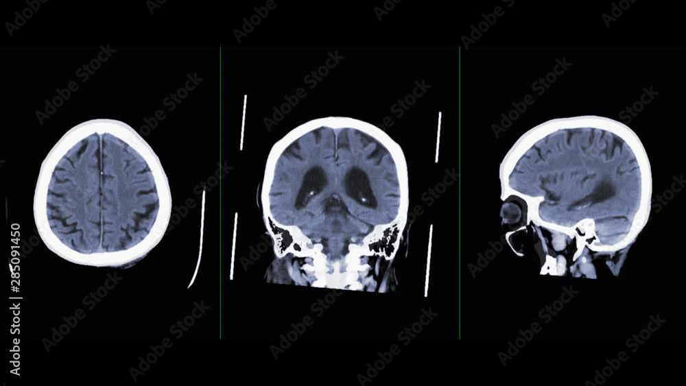 Vídeo do Stock: CT scan of the brain or CT brain scan axial, coronal ...