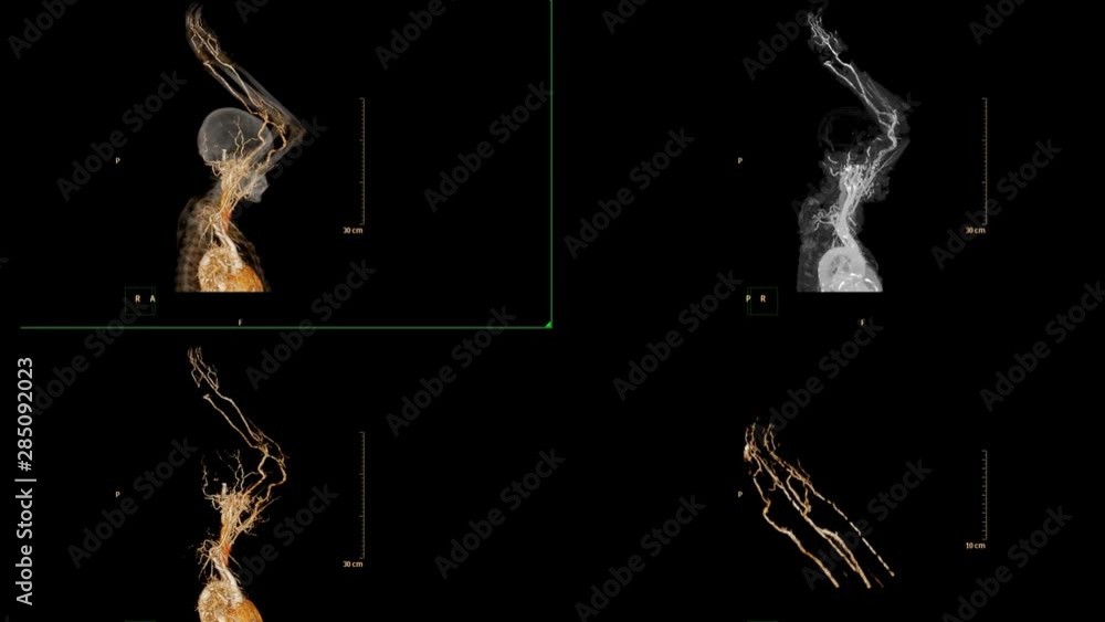 Multi VIEW of CTA brachial artery or CT scan of upper extremity 3d ...