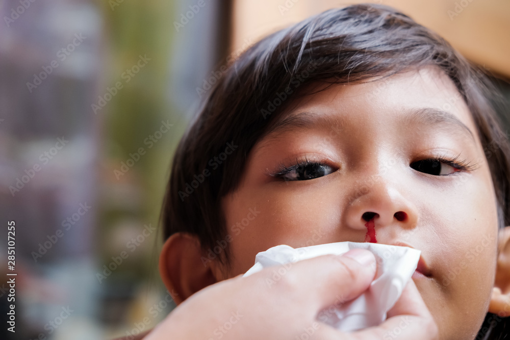 Cute Asian Little Boy Having Nosebleed Stock Photo | Adobe Stock