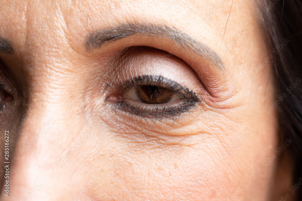 Close up of woman face showing eye affected of drooping eyelid after ...