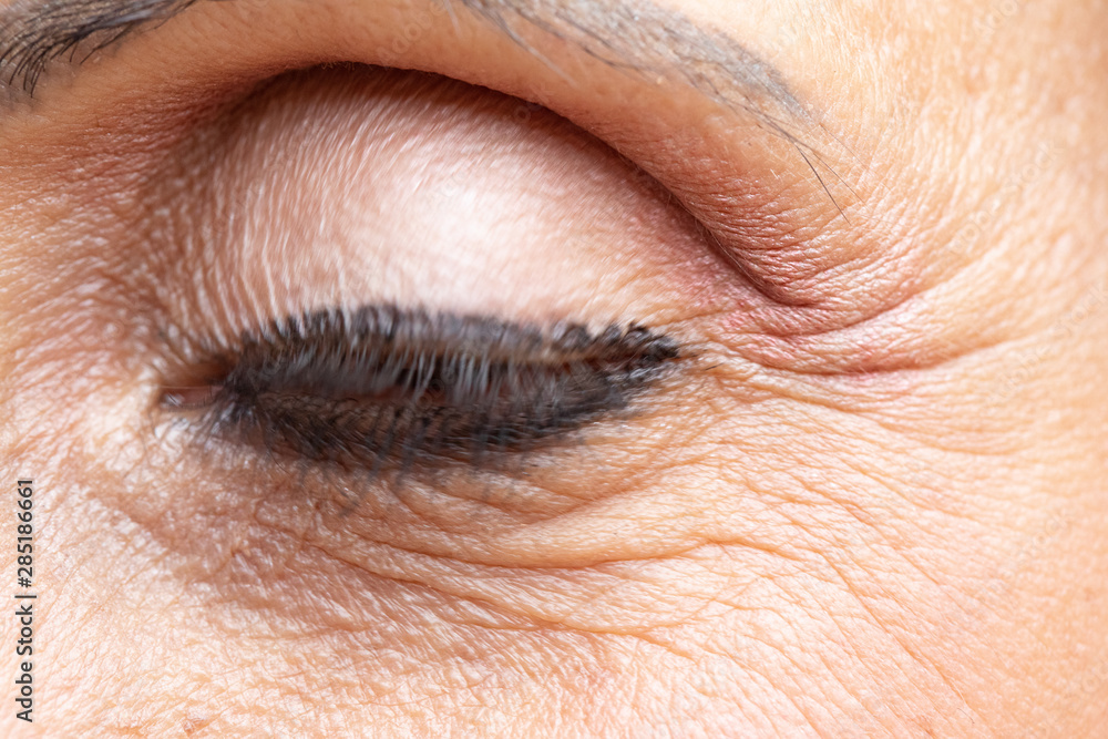 Extreme close up of woman eye suffering from drooping eyelid after ...