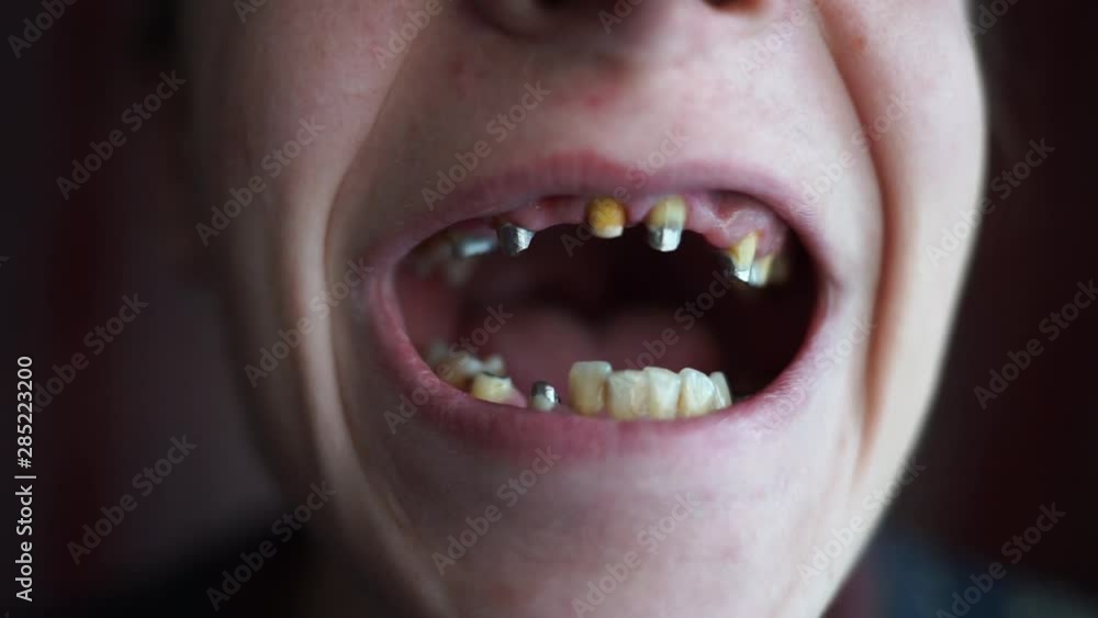 Video „A man with very bad teeth. Diseases of teeth and gums. Toothless ...