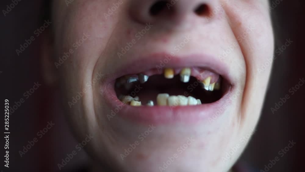 A man with very bad teeth. Diseases of teeth and gums. Toothless young ...