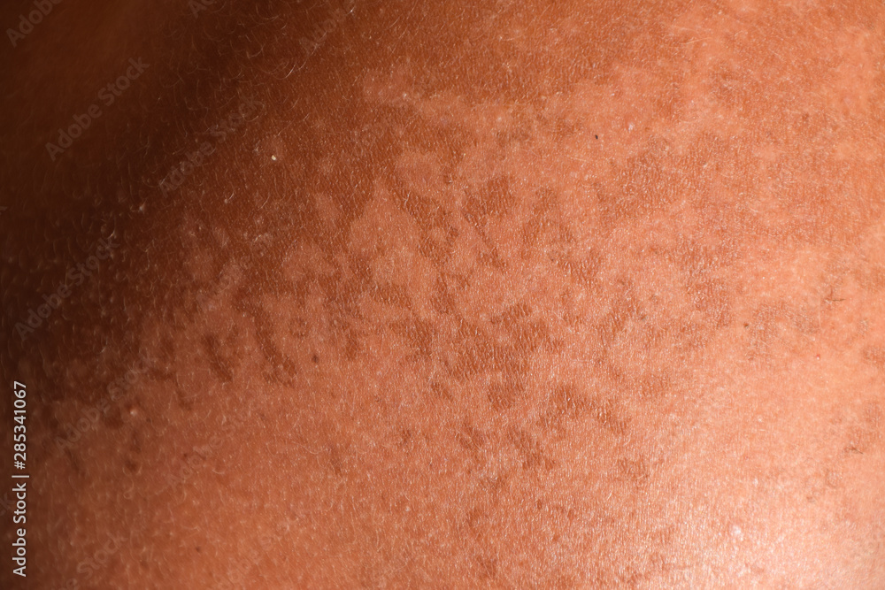 Sunburn on the skin of the shoulders. Exfoliation, skin peels off ...