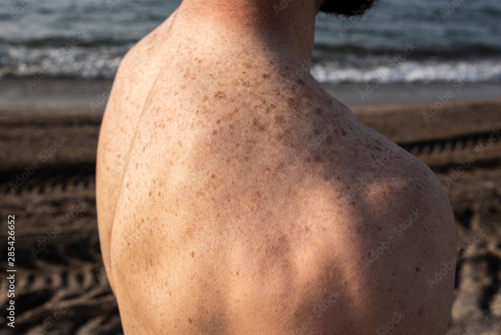 shoulder skin with spots, freckles and moles due to the sun Stock Photo ...