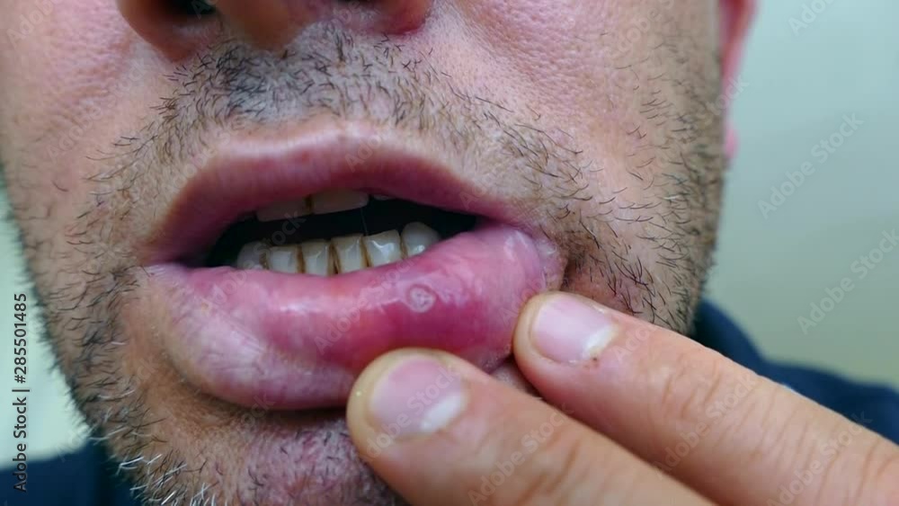 man with aphthae on lip. thrush, canker sores in the oral cavity of ...