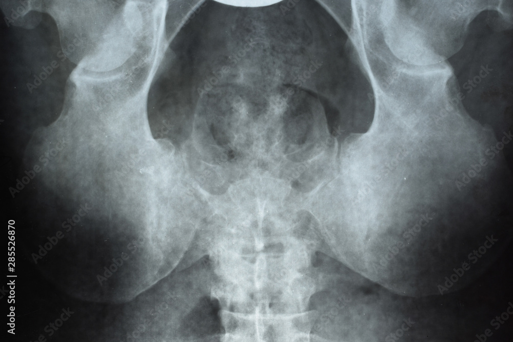 X-ray of the pelvis and sacrum. X-ray Stock Photo | Adobe Stock