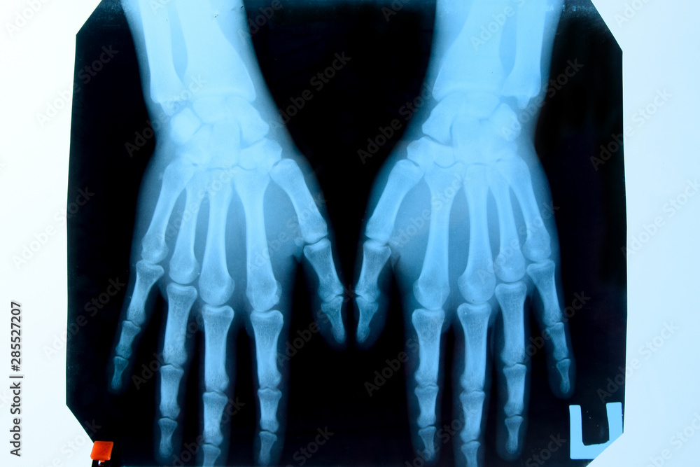 X ray of the hands, a picture of the bones of the hands on the x-ray ...